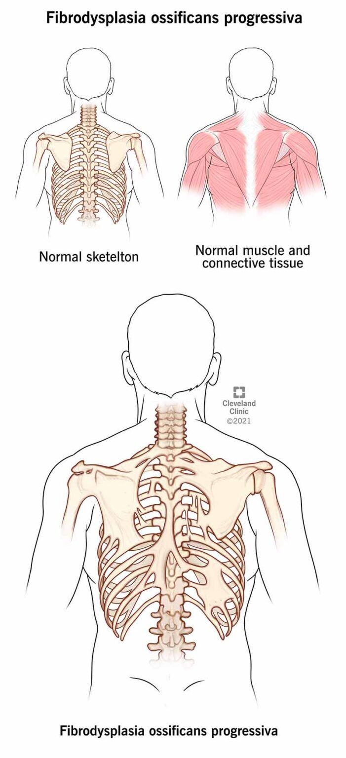 What is Stoneman Syndrome? | Science Snap