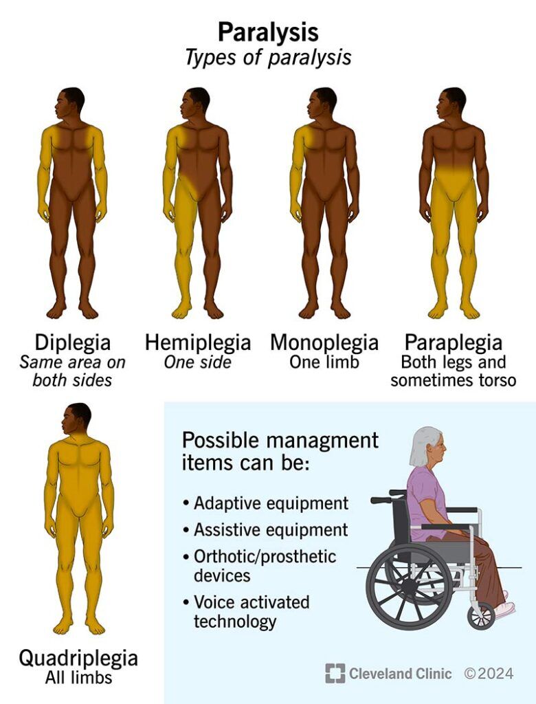 Paralysis: Causes, Forms, and Treatments | Science Snap